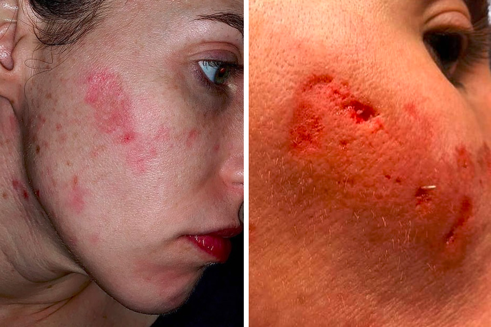 Rosto De Doenca Comedora De Carne